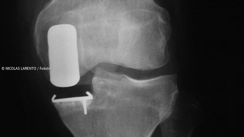 ᐅ Die Osteosynthese zur Fixierung des Knochens - Ablauf, Materialien ...