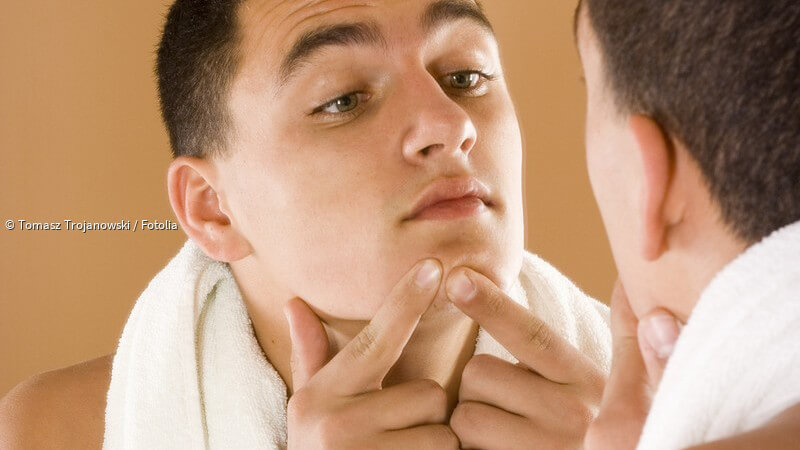 ᐅ Acne comedonica - Leichte und durch Mitesser geprägte Form der Akne