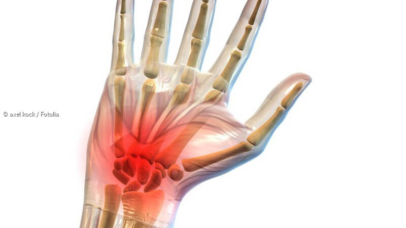 ᐅ Kahnbeinbruch - Fraktur des Kahnbeins: Ursachen, Symptome und Behandlung