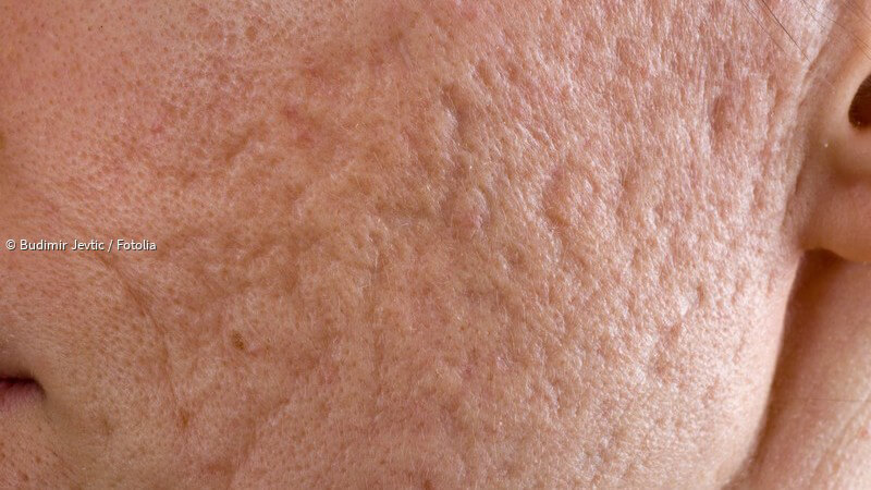 ᐅ Aknenarben - Narben infolge von Pickeln und Hautentzündungen