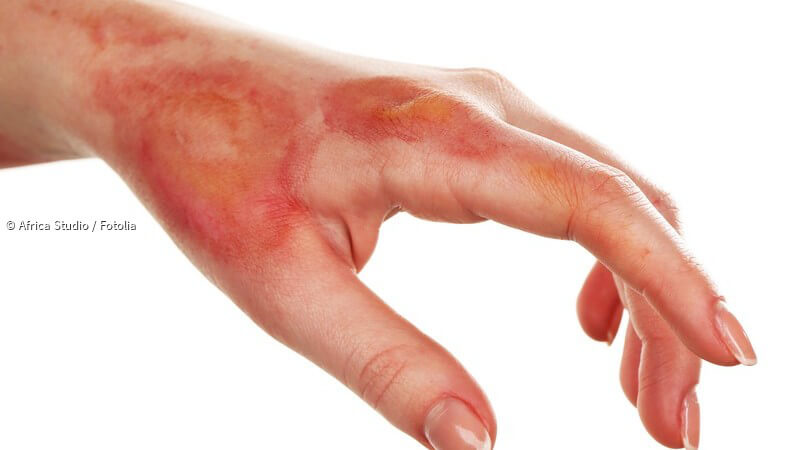 ᐅ Brandnarben - Narben infolge von Verbrennungen der Haut