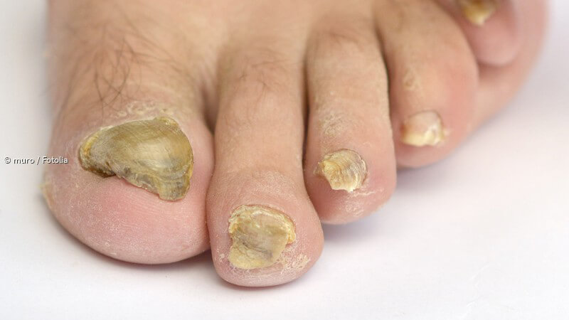 ᐅ Merkmale, Vorkommen und entstehende Erkrankungen (Mykosen ...