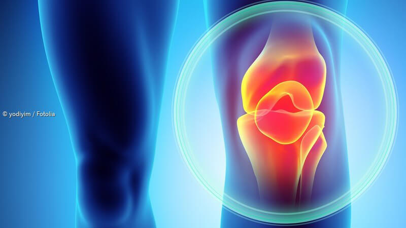 ᐅ Arthrose - Ursachen, Symptome und Behandlung