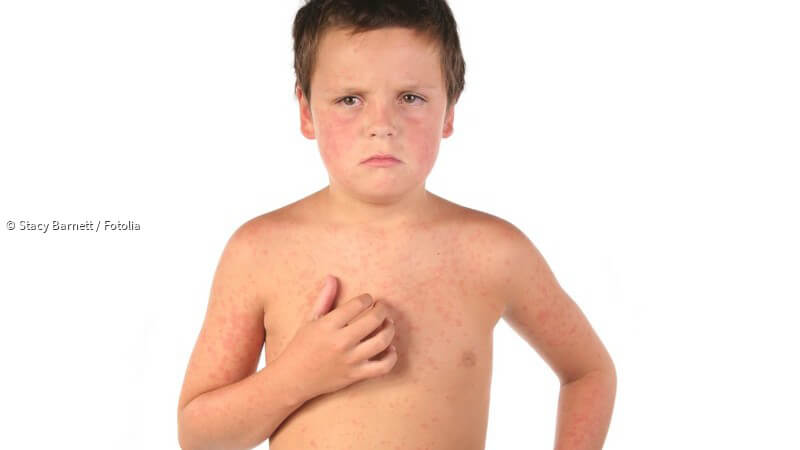 ᐅ Röschenflechte (pityriasis rosea) - Wie kommt es dazu und wie wird ...