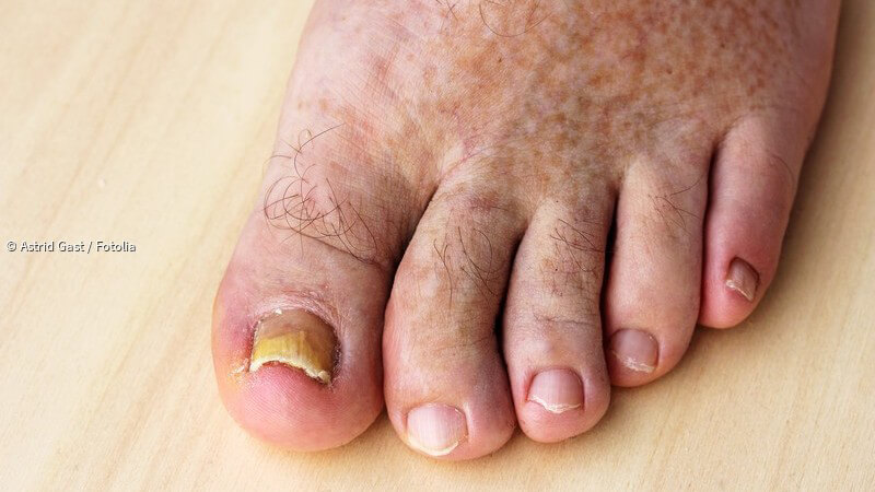 ᐅ Dermatophyten (Fadenpilze)