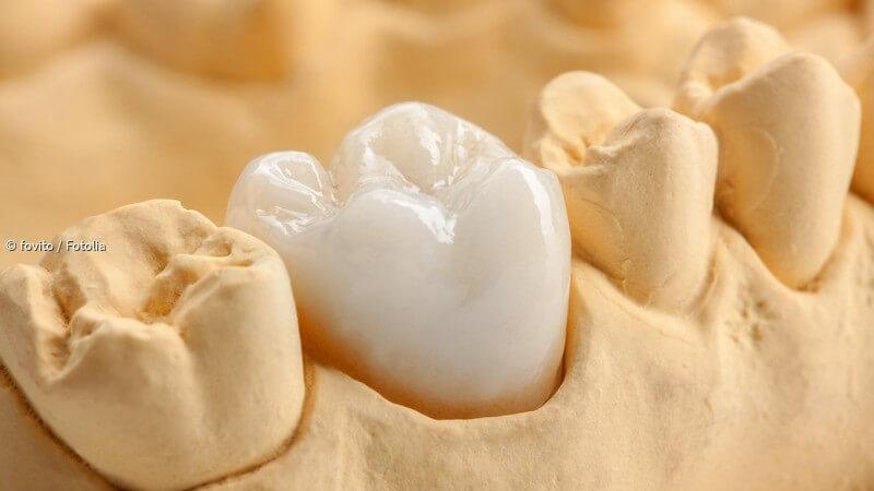 ᐅ Zahnkronen - Merkmale, Funktion und Behandlungsablauf