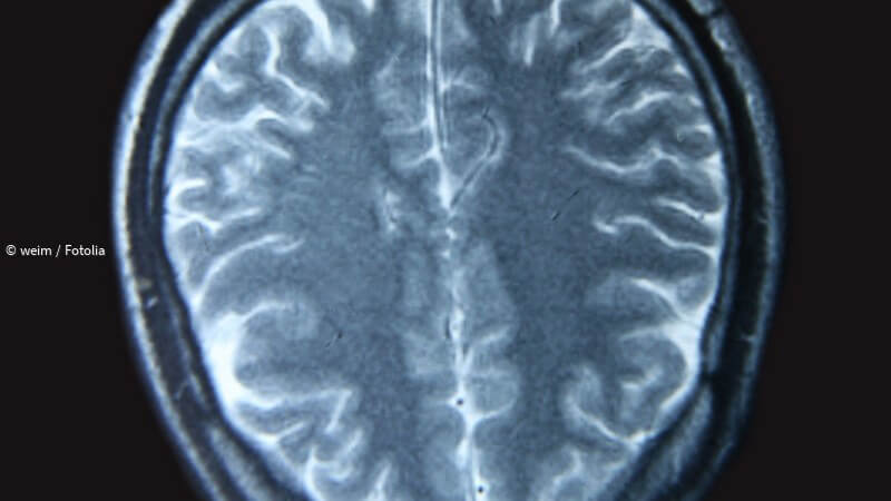 ᐅ Neuroblastom - Ursachen, Symptome und Behandlung