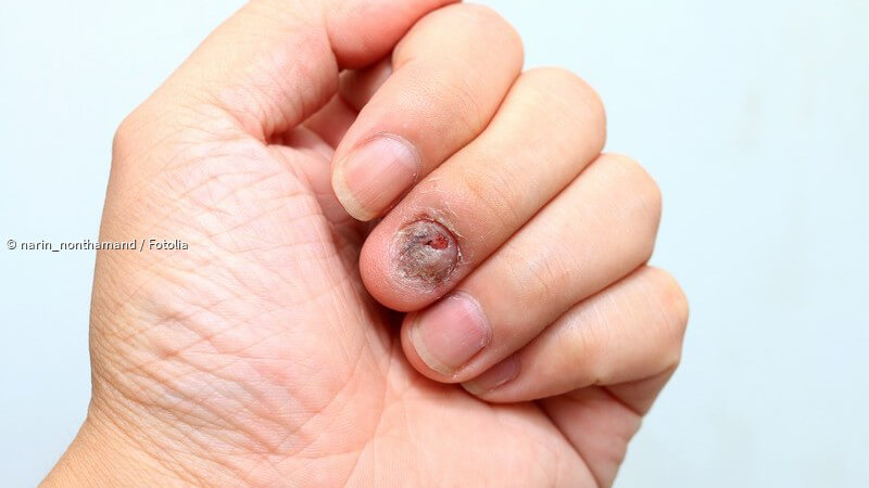 ᐅ Pilzinfektionen - Ursachen, Symptome und Behandlung