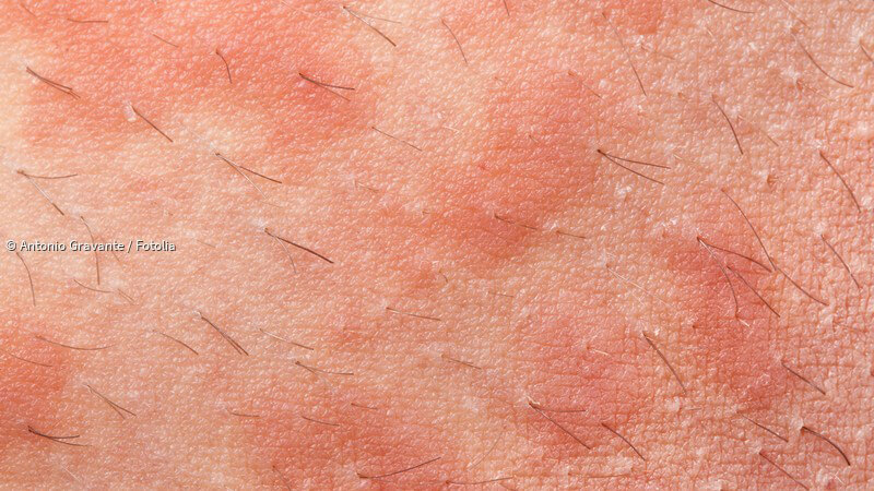 ᐅ Quaddeln - Ursachen und Behandlung